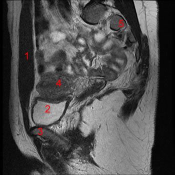 MRI of the Female Pelvis - W-Radiology