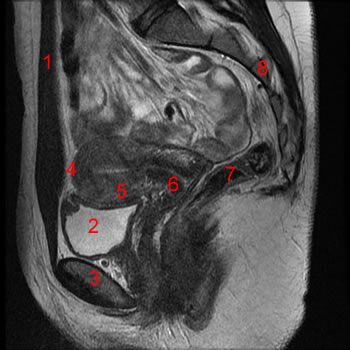 MRI of the Female Pelvis - W-Radiology
