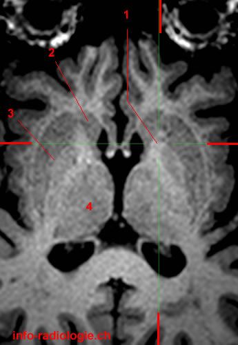 Internal capsule - W-Radiology