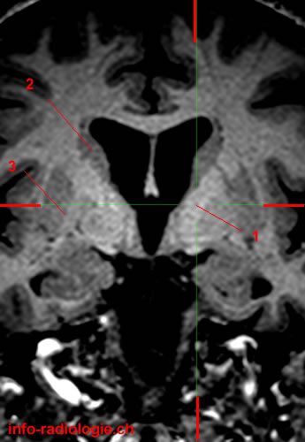 Internal capsule - W-Radiology