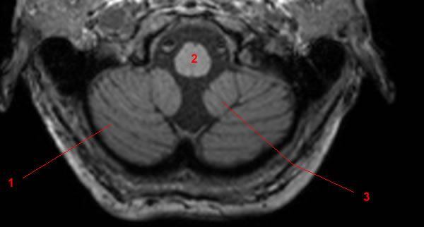 Cerebellum - W-Radiology