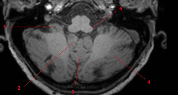 Cerebellum - W-Radiology