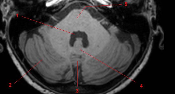 Cerebellum - W-Radiology