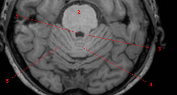 Cerebellar Vermis In Mass