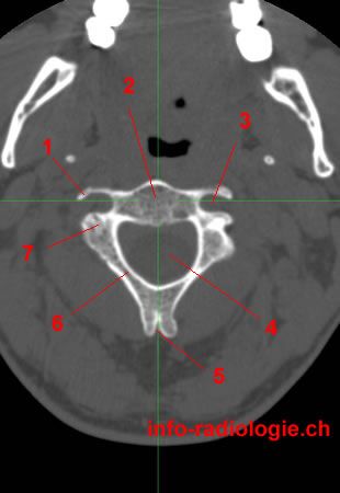 CT of the Craniocervical junction - W-Radiology