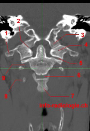CT of the Craniocervical junction - W-Radiology
