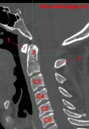 CT of the Craniocervical junction - W-Radiology