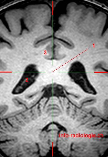 corpus callosum splenium