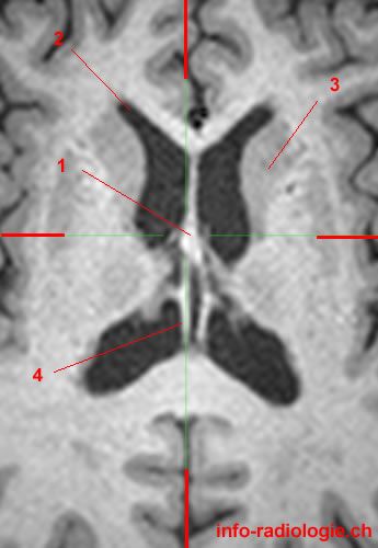 Fornix of the Brain - W-Radiology