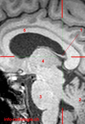 Fornix of the Brain - W-Radiology