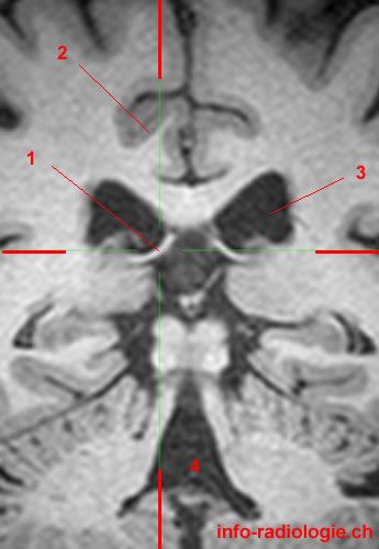 Fornix of the Brain - W-Radiology