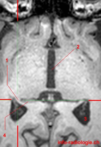 Fornix of the Brain - W-Radiology