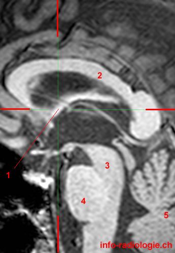 Fornix of the Brain - W-Radiology