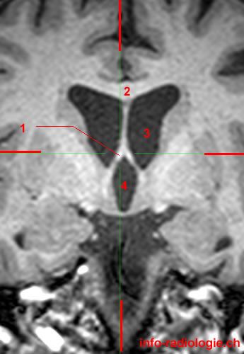 Fornix of the Brain - W-Radiology