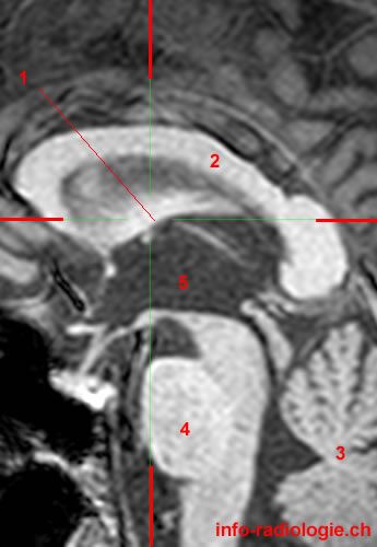 Fornix of the Brain - W-Radiology