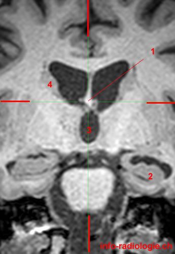 Fornix of the Brain - W-Radiology