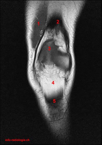 mri knee coronal view