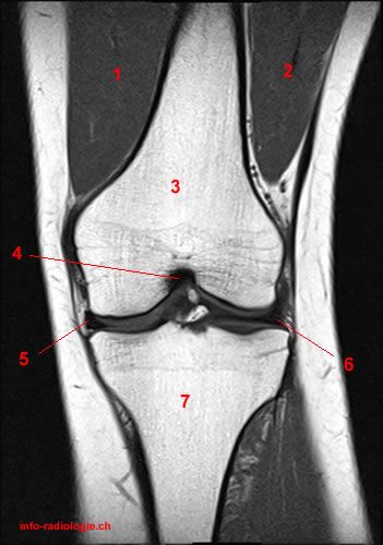 mri knee coronal view