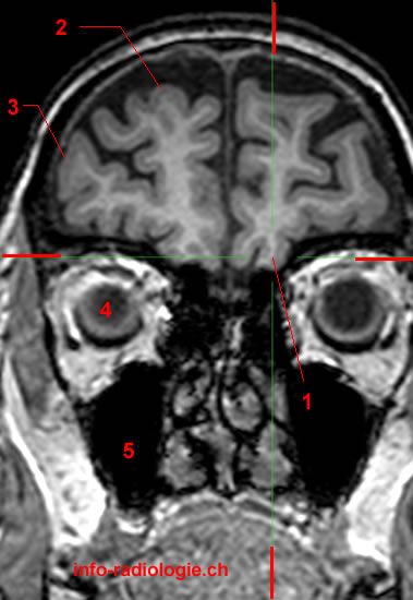 Inferior Frontal Gyrus Mri Table #11