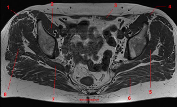 MRI of the Hip: Detailed Anatomy - W-Radiology