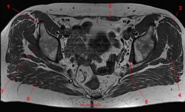 MRI of the Hip: Detailed Anatomy - W-Radiology