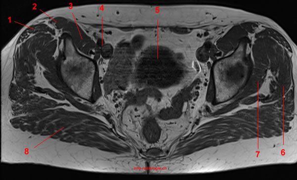 MRI of the Hip: Detailed Anatomy - W-Radiology