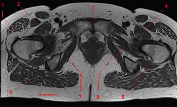 MRI of the Hip: Detailed Anatomy - W-Radiology