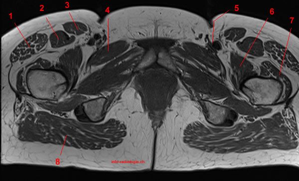 MRI of the Hip: Detailed Anatomy - W-Radiology