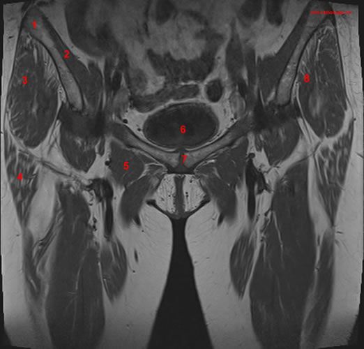 MRI of the Hip: Detailed Anatomy - W-Radiology