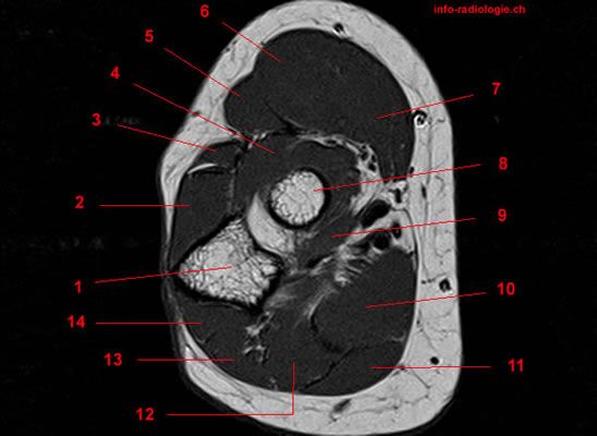 MRI of the Elbow: Detailed Anatomy - W-Radiology