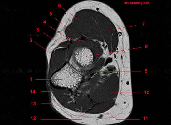 MRI of the Elbow: Detailed Anatomy - W-Radiology