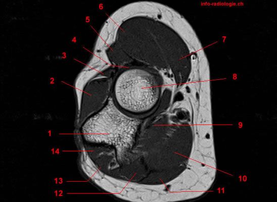 Elbow Anatomy Mri Elbow Coronal MRI 1 Diagram | Quizlet