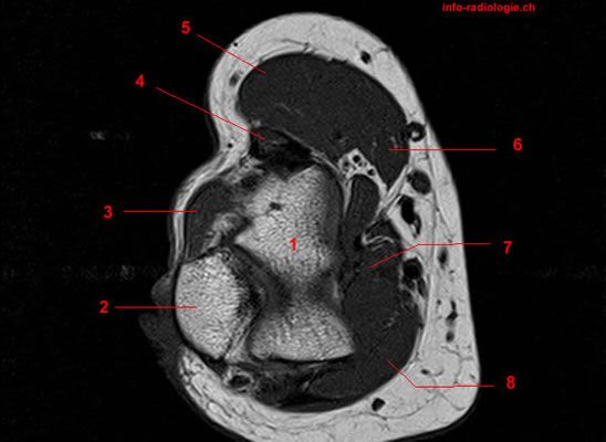 MRI of the Elbow: Detailed Anatomy - W-Radiology