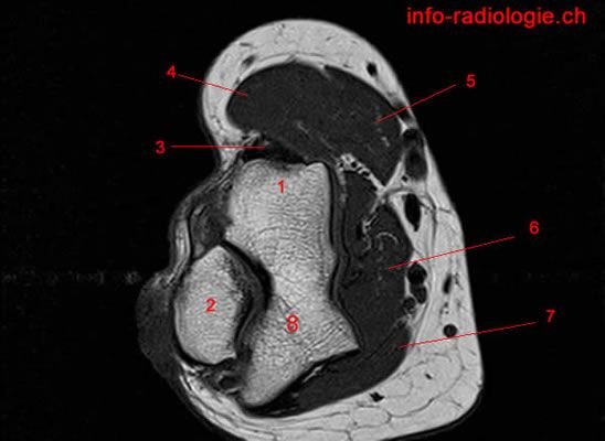 MRI of the Elbow: Detailed Anatomy - W-Radiology