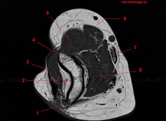 MRI of the Elbow: Detailed Anatomy - W-Radiology