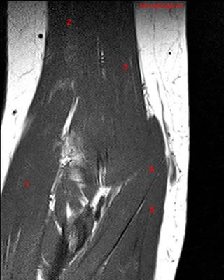 MRI of the Elbow: Detailed Anatomy - W-Radiology