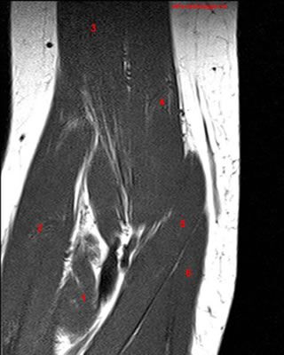 MRI of the Elbow: Detailed Anatomy - W-Radiology