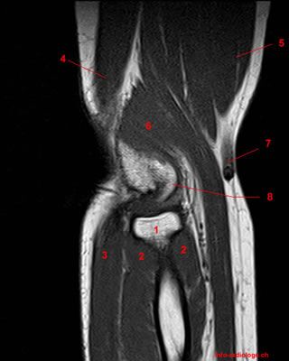 MRI of the Elbow: Detailed Anatomy - W-Radiology