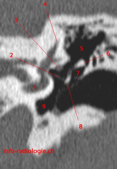 CT scan of the middle ear (anatomy) - W-Radiology