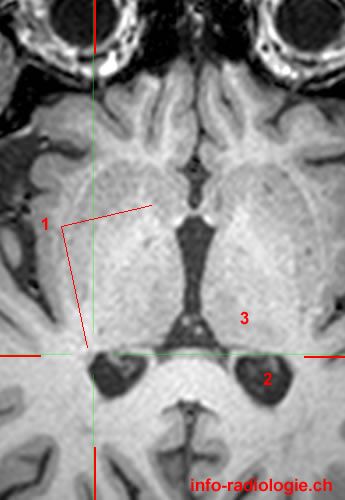 Caudate Nucleus - W-Radiology