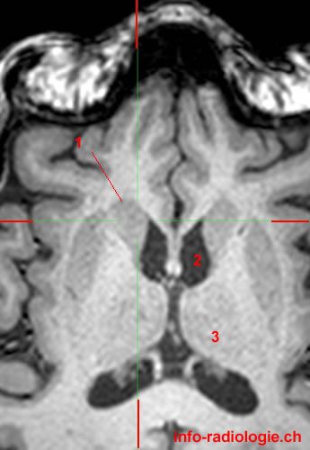 Caudate Nucleus - W-Radiology