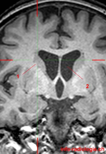 Caudate Nucleus - W-Radiology
