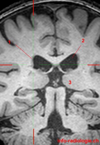 Caudate Nucleus - W-Radiology