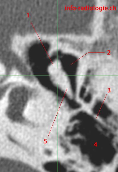 CT scan of the middle ear (anatomy) - W-Radiology