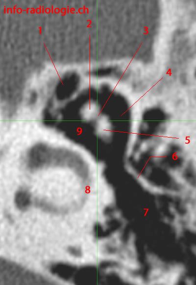 CT scan of the middle ear (anatomy) - W-Radiology