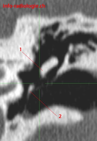 CT scan of the middle ear (anatomy) - W-Radiology