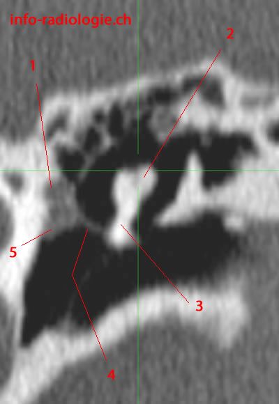 CT scan of the middle ear (anatomy) - W-Radiology