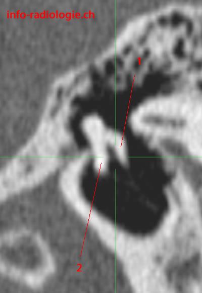 CT scan of the middle ear (anatomy) - W-Radiology