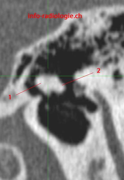 CT scan of the middle ear (anatomy) - W-Radiology