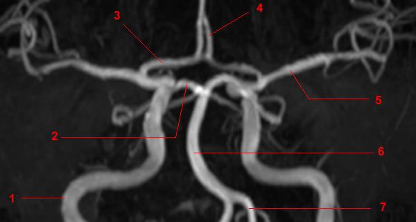 Circle Of Willis Angiogram